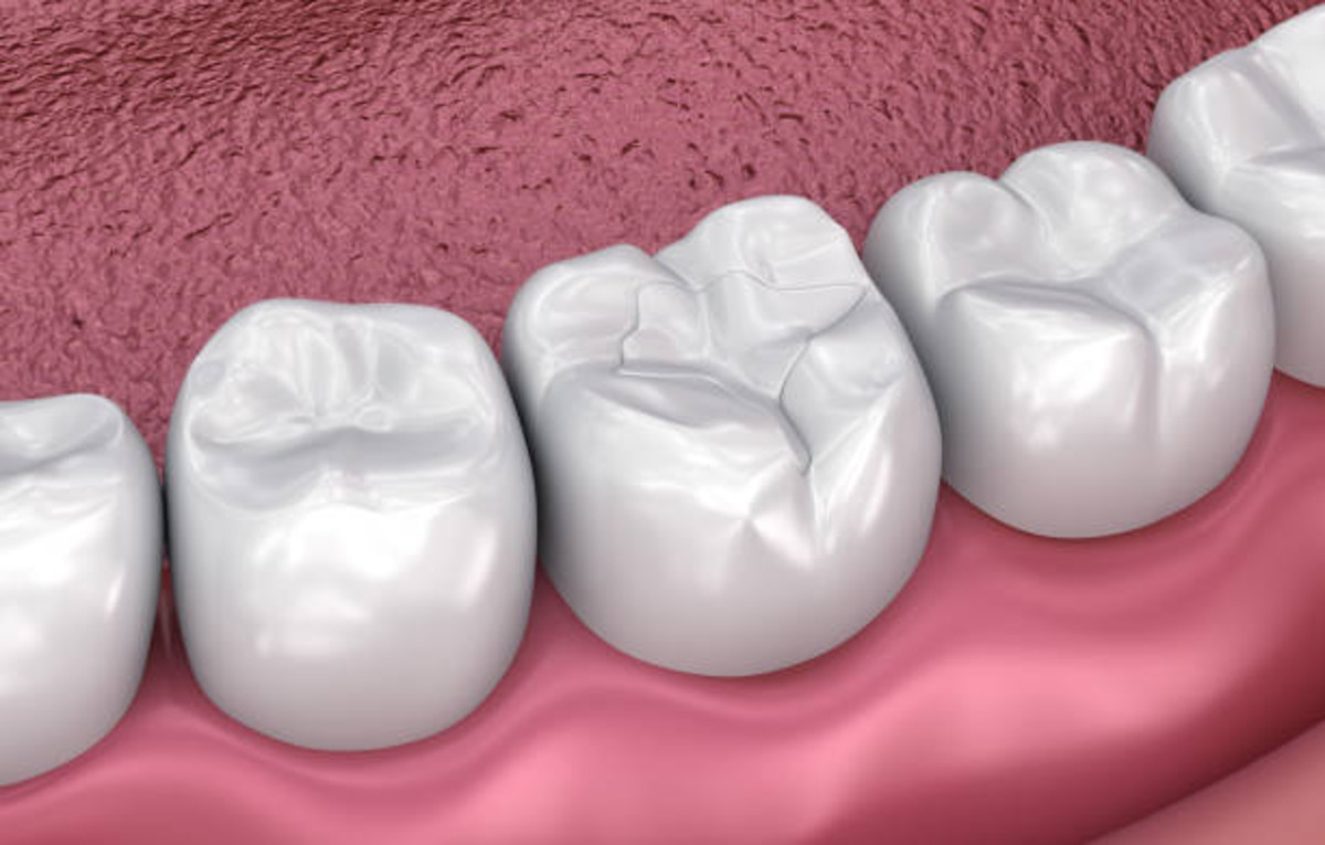 Why White Fillings Are the New Standard in Dentistry